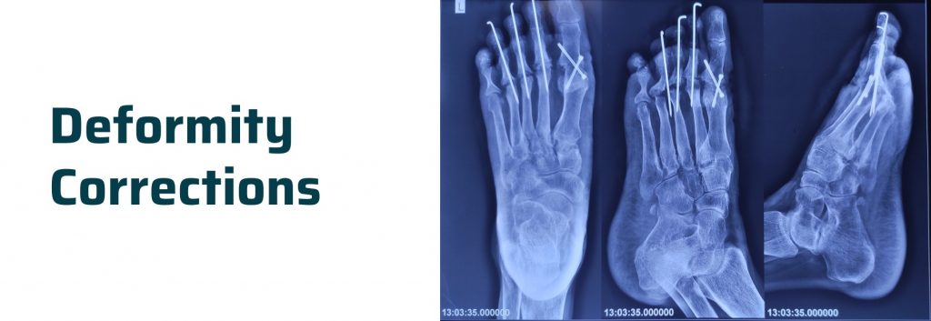 Deformity Corrections - Dr. Rachit Sheth