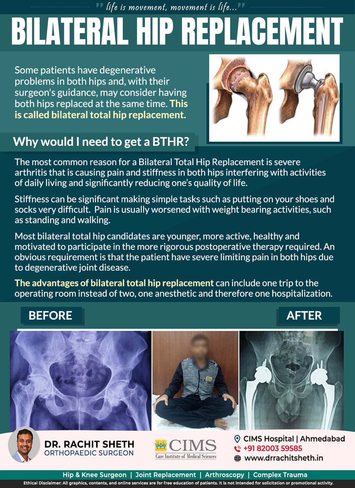 Bilateral Hip Replacement Dr Rachit Sheth Bilateral Hip Replacement Dr Rachit Sheth