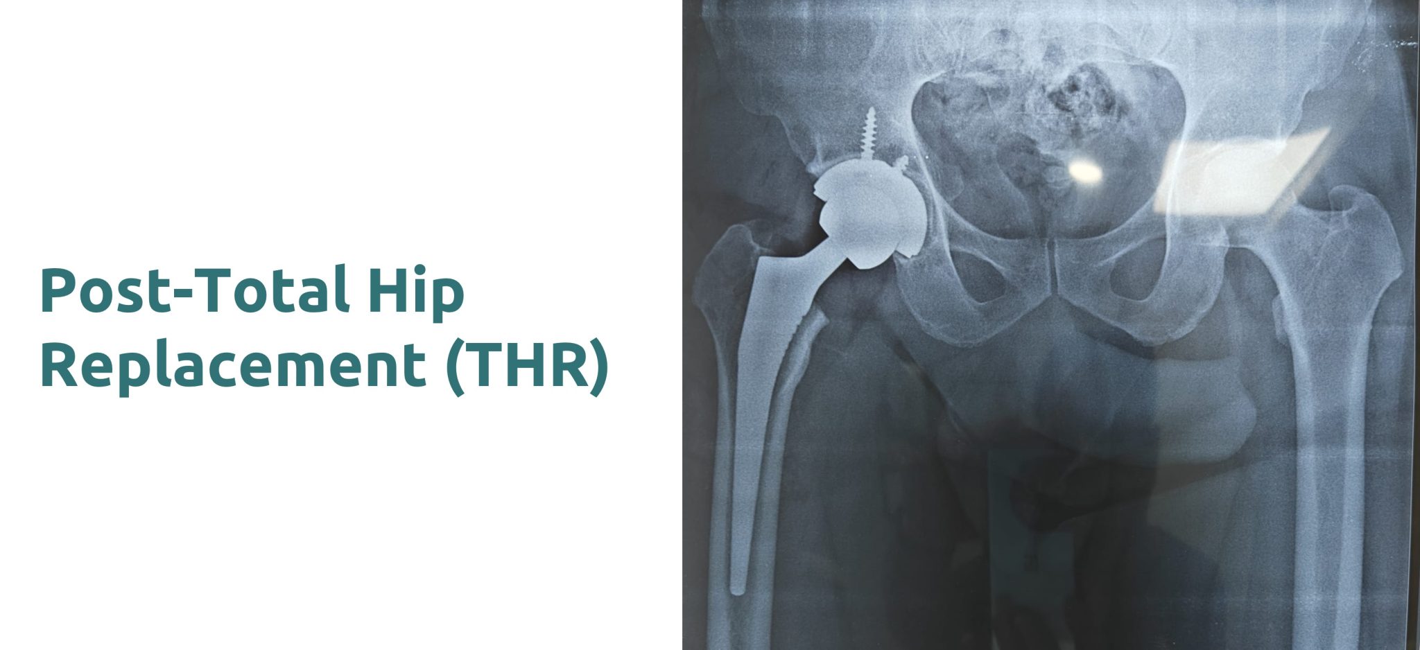 Post-COVID AVN of the Hip Joint: A Rising Concern